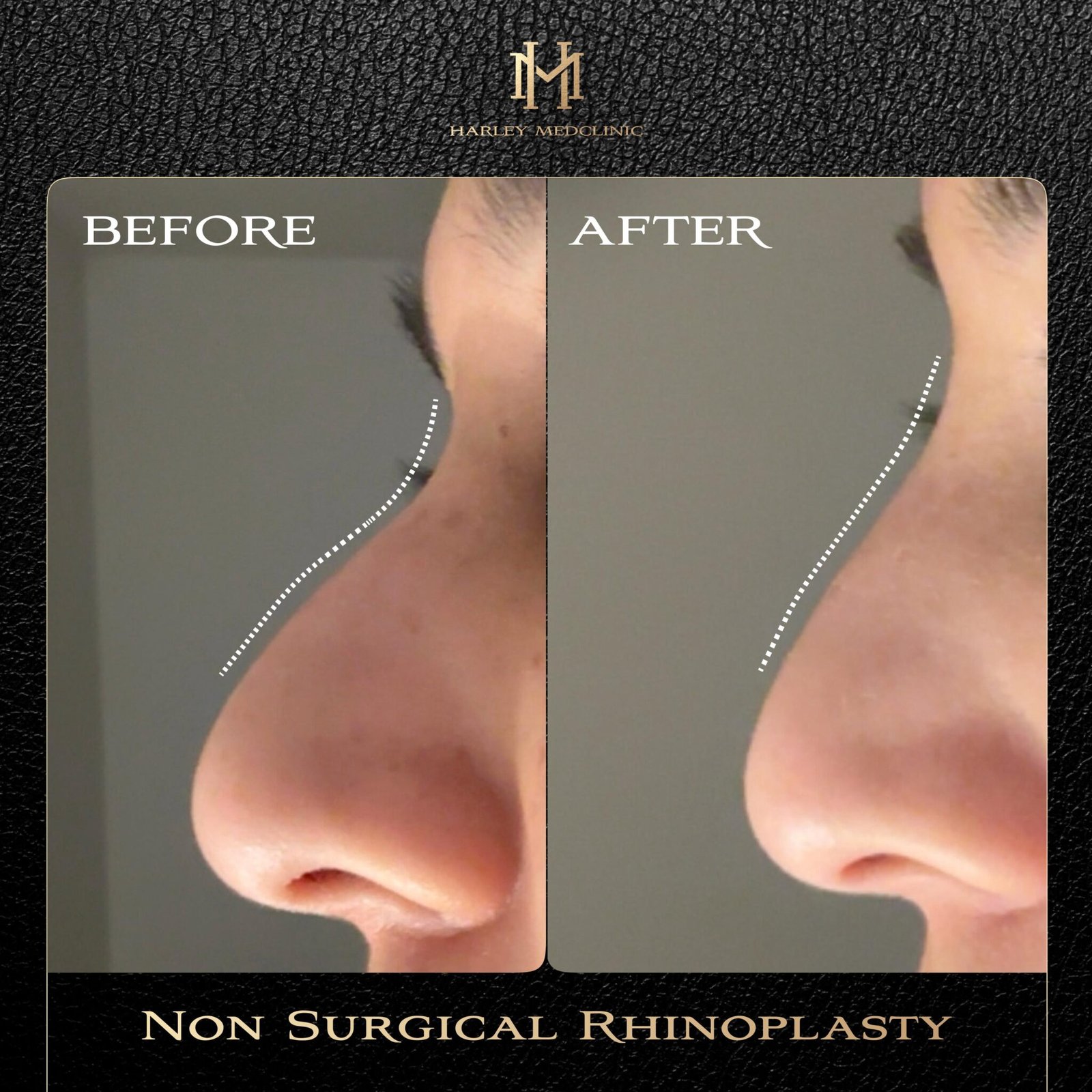 Non Surgical Rhinoplasty – Harley Medclinic